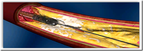 FDA approves Pathway Medical's system for Plaque removal - Medical Quack